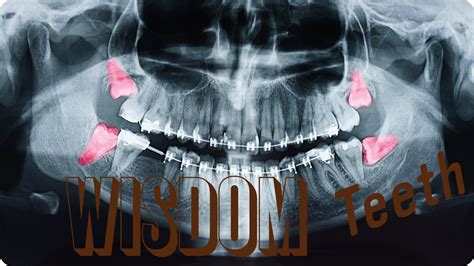 Can Wisdom Teeth Cause Headaches Learn The Connection
