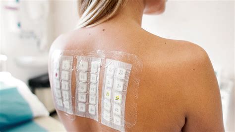 Eczema Skin Patch Test Procedure And Possible Side Effects