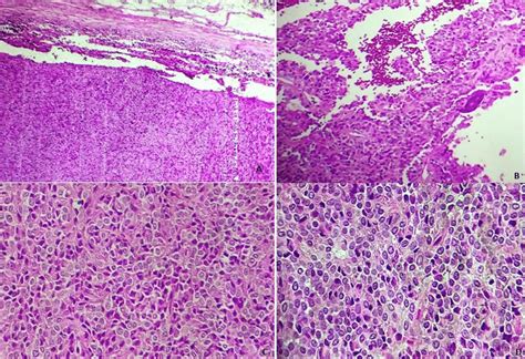 A Encapsulated Tumor Composed Of Cellular Diffuse Sheetshex4 B Few