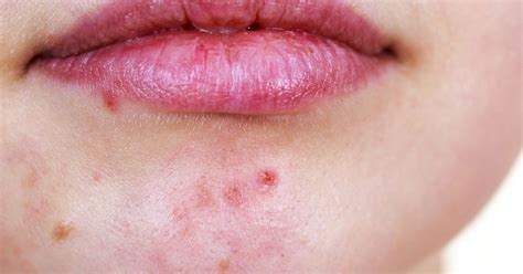 턱에 난 여드름 자궁 안 좋단 신호 전문의에게 물었다