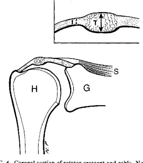 The Rotator Crescent And Rotator Cable An Anatomic Description Of The Shoulders Suspension