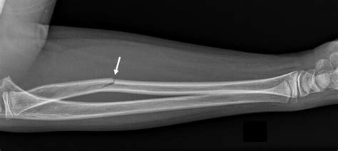 Fracture Du Radius La Revue Du Praticien