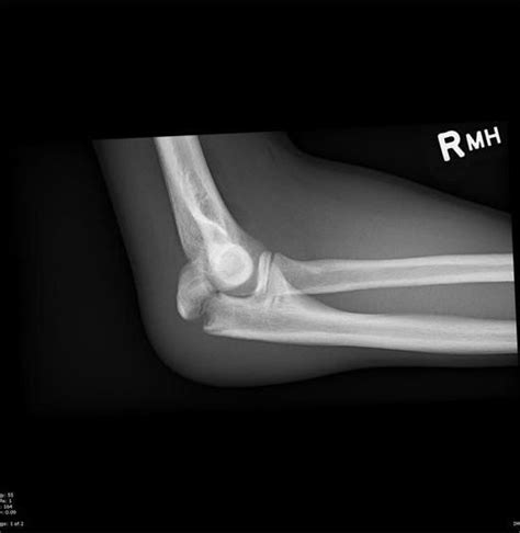 Olecranon Fracture Buyxraysonline