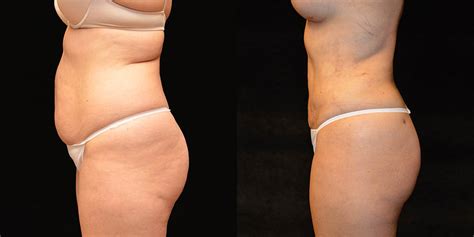 Patient 2754 Liposuction Before And After Photos Baltimore Plastic