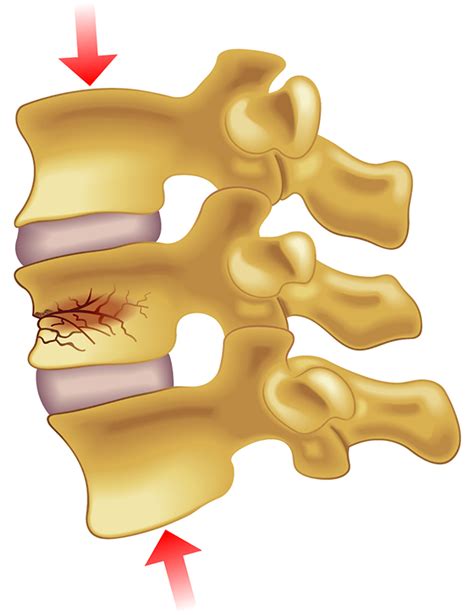 Compression Fracture Pathophysiology At Roberta Walters Blog