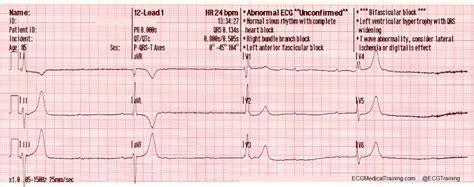 Lafb Ecg