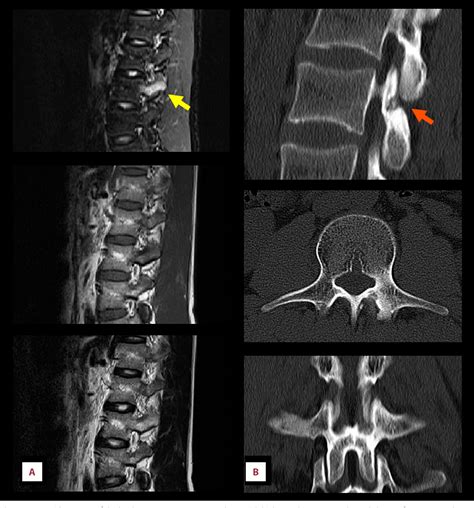 Osteoid Osteoma Of The Femoral Head Treated By