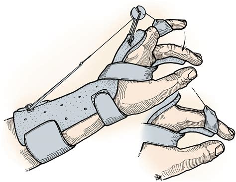 Extensor Tendon Injury Clinical Tree