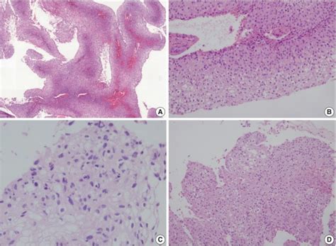 Liquid Based Cytology Features Of Papillary Squamotransitional Cell