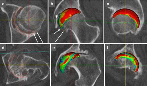 Planning Of Position And Osteointegration Of The Cup A D Axial Download Scientific Diagram