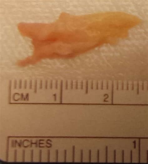 Morton S Neuroma