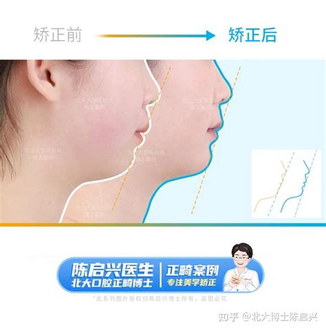 舌侧矫正改善骨性嘴凸 深覆合 露龈笑案例 知乎