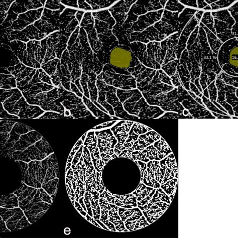 Evaluation Of The Macular Perfusion Density Pd The Image Of The Download Scientific Diagram