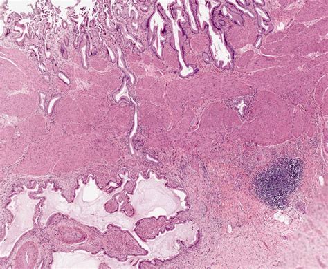 Pathology Outlines Chronic Cholecystitis