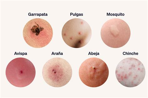 Enséñame Las Picaduras Y Te Diré Qué Hacer En Cada Caso