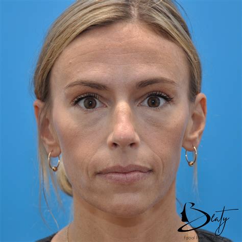 Upper Blepharoplasty And Brow Lift Case 13253 Beaty Facial Plastic
