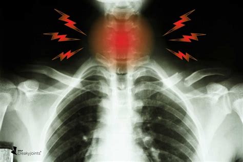 How Does Scleroderma Affect The Esophagus The Red Flags To Be Aware Of