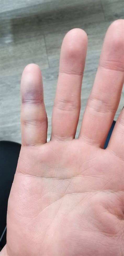 운동중 새끼손가락 인대 완전파열 비수술 보존요법 후기