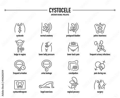Cystocele Anterior Vaginal Prolapse Symptoms Diagnostic And Treatment