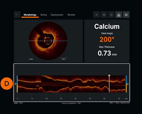 Optical Coherence Tomography Oct Intravascular Imaging Abbott
