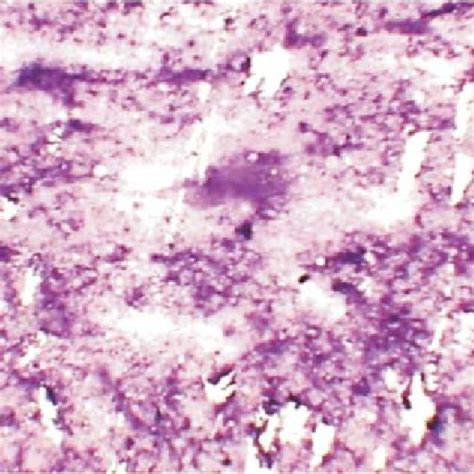 Microphotograph Of Fnac Lymph Node Smear Showing Granuloma Mgg Stain