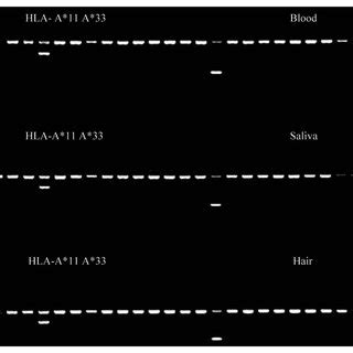 An Agarose Gel Showing Representative SSP Based Typing Of HLA A Download Scientific