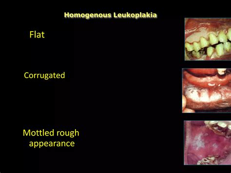 Leukoplakia Pptx Dental Health Diseases And Conditions