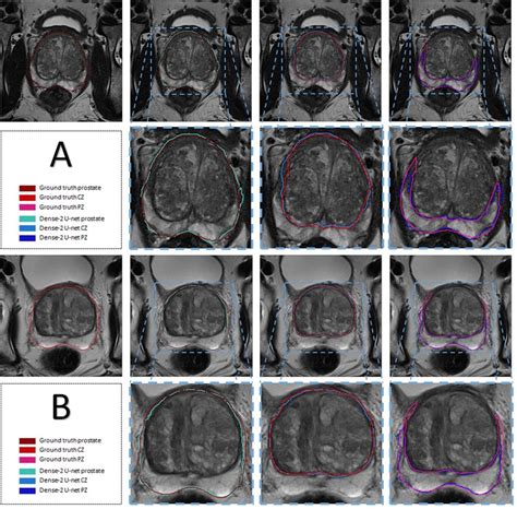 Prostate Anatomy Zones Mri At Catherine Moore Blog