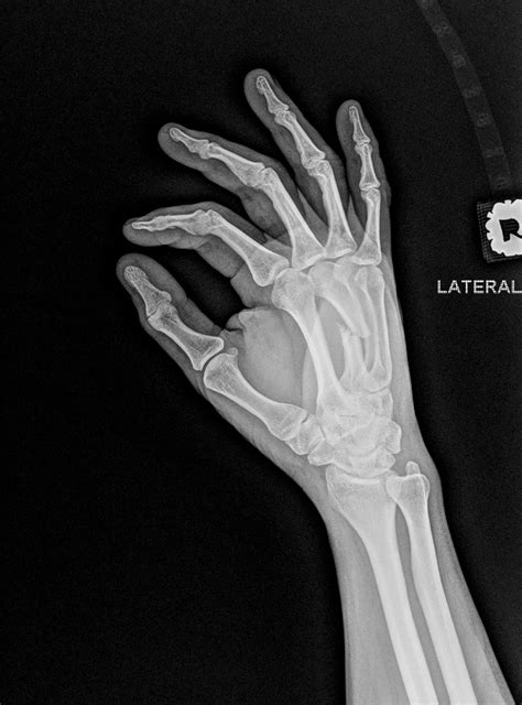 Displaced Closed Fracture Of Right 3rd Metacarpal Uni Clinic