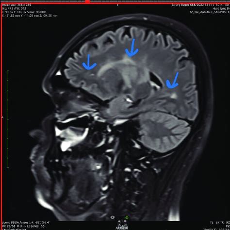 Shows The T2 Weighted Mri Sagittal Section Performed On 29 August Download Scientific Diagram