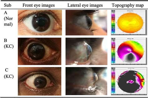 Table 2 From Keratoconus Detection Using The Fusion Features Of