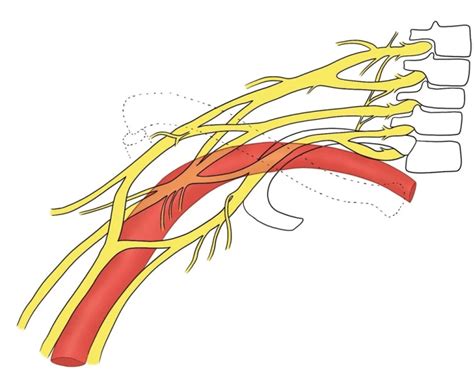 Brachial Blexus Quiz