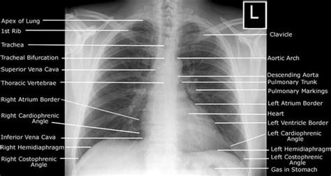 Normal Chest Xray Labeled