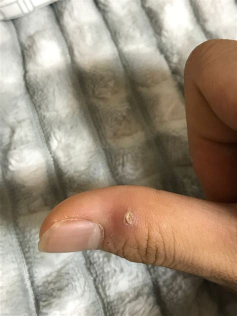 파상풍초기증상 지식in