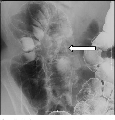 Figure 4 From A Case Of Concomitant Small Bowel Gist And Colorectal Cancer Treated By