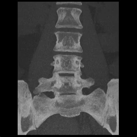 Transitional Vertebrae Osteomag