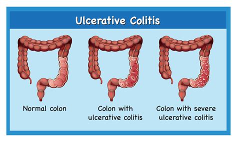 What Is Ulcertive Colitis Causes Of UC And Sign And Symptoms Diagnosis And Treatment