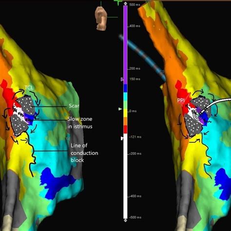 Activation Map Of The Atrial Flutter Showing Nearly The Entire Cycle