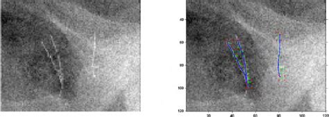Fiducial Marker Detection Results On Kv Image At An Oblique View Download Scientific Diagram