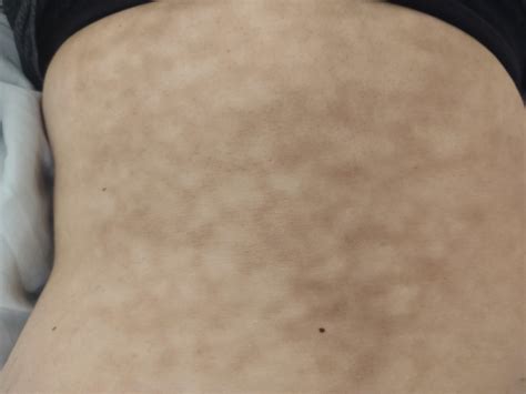 Back Bruising Details In The Comments Rfibromyalgia