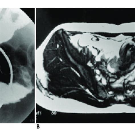 A 43 Year Old Woman With Intussusception Due To Inflammatory Polyp A
