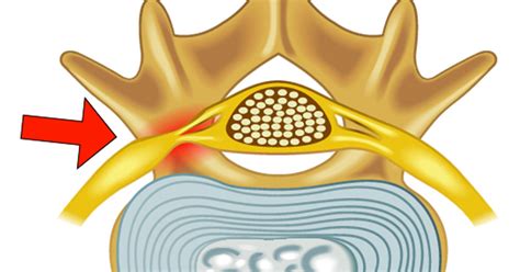 Neural Foraminal Stenosis