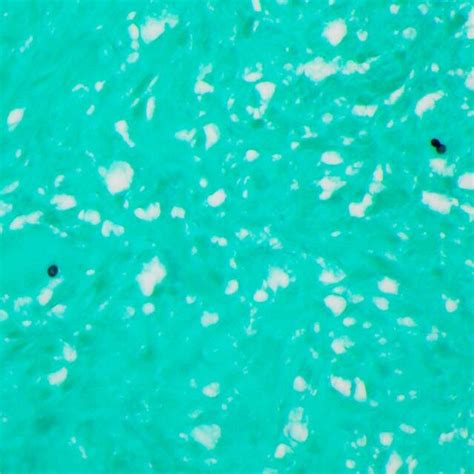 Non Necrotizing Granulomatous Inflammation Present In Omental Adipose Download Scientific