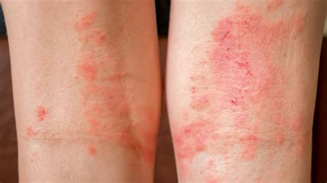 Seborrheic Dermatitis According To The Nhs Causes And Treatments