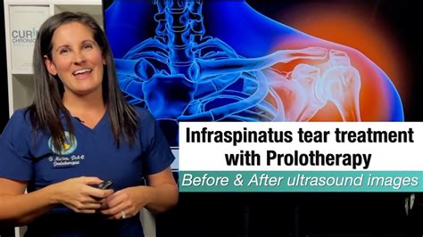 Infraspinatus Tear Healing With Prolotherapy Before And After Ultrasound Case Presentation Youtube