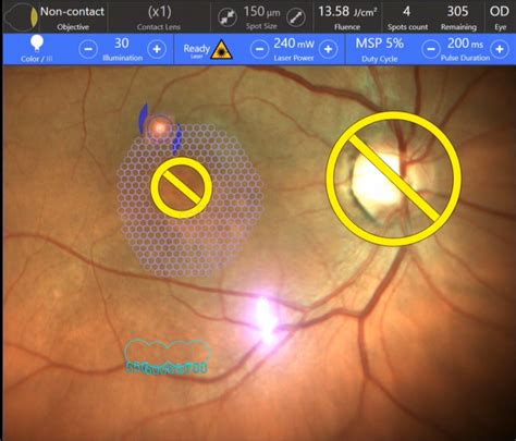 Od Os Inc On Linkedin Navilas Retina Ophthalmology Ophthalmologist Navigation Noncontact…