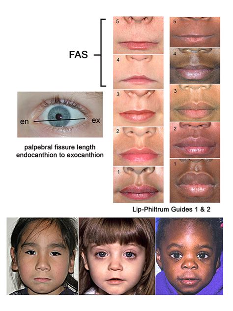 Fetal Alcohol Syndrome Eyes Far Apart