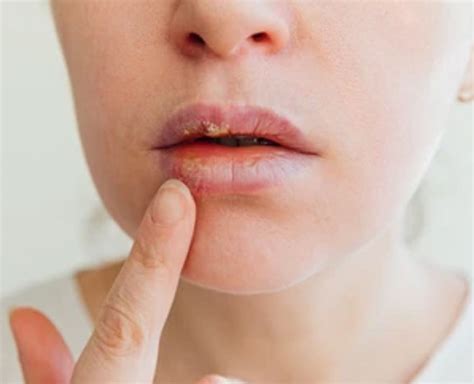 हठ पर बर बर नकल आत ह पपलस इन नसख स मलग रहत pimples on lips home