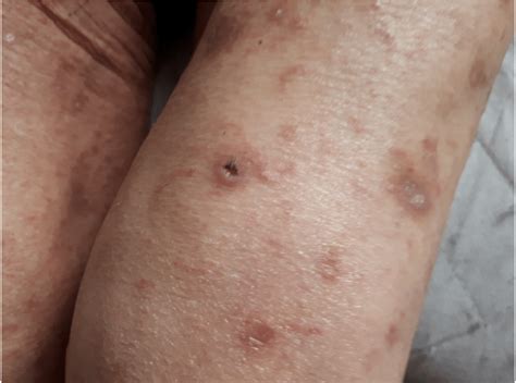 Crusted Scabies On Elbow