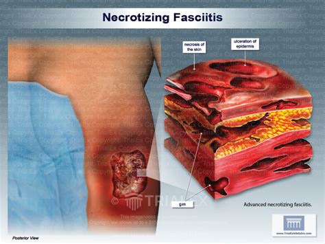 Necrotizing Fasciitis